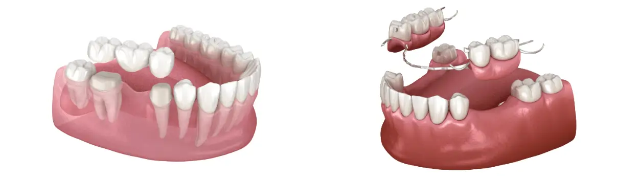 Dentures vs Bridges: Which is a better option? - Teeth Wisdom